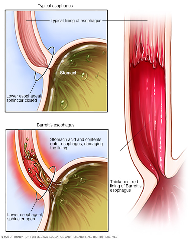 Barretts Esophagus Disease Reference Guide