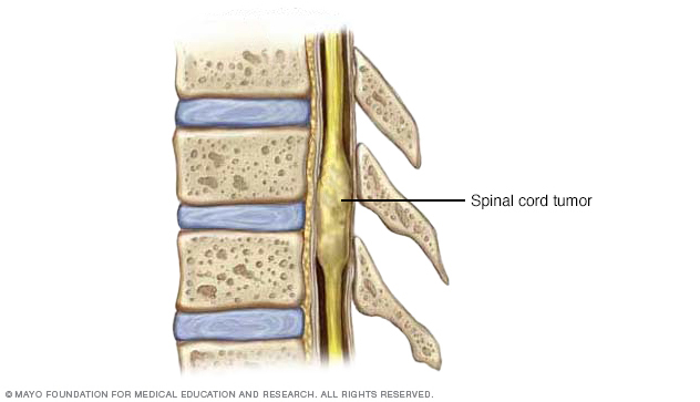 Spinal Cord Tumor Disease Reference Guide