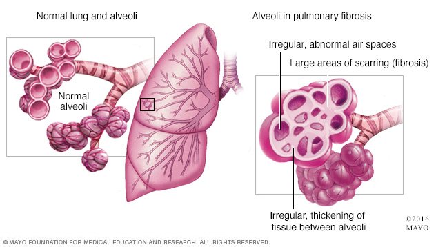 Pulmonary fibrosis Disease Reference Guide - Drugs.com Pulmonary fibrosis Disease Reference Guide - Drugs.com