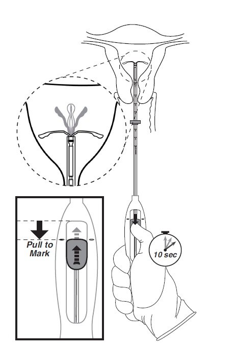 Skyla Iud Fda Prescribing Information Side Effects And Uses